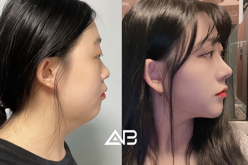 Cara Menghilangkan Double Chin: Double Chin Lifting vs. Opsi Non-Bedah ...