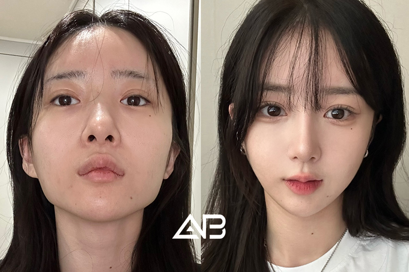 Facial Contouring: Teknik dan Prosedur Soft Tissue Contouring di Korea ...