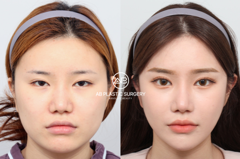 Mengapa Memilih 3 Jenis Facial Contouring Dibandingkan Lainnya