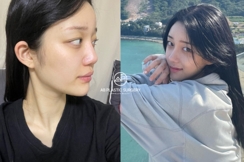 Kekhawatiran tentang Hidung Pesek: Bagaimana Rhinoplasty Dapat Membantu