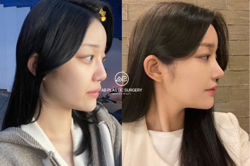 Cara Memperbaiki Hidung Pesek dengan Operasi dan Tanpa Operasi