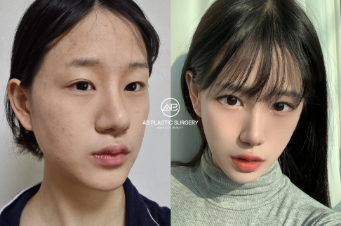 Operasi Mata Almond (Canthoplasty) di Korea