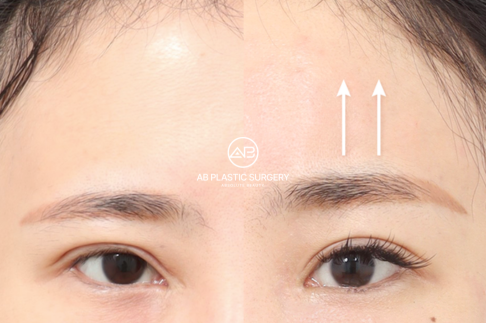 5 Fakta Penting tentang Operasi Brow Lift di Korea yang Tidak Boleh ...